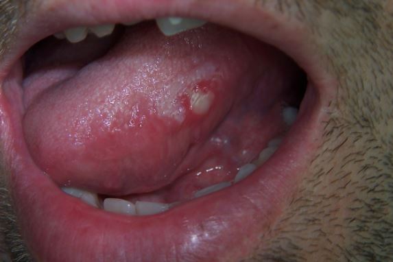 White Patches In Mouth Pictures Small White Spots On Roof Of Mouth