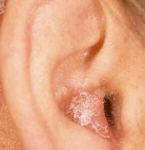 Scab in Ear that Won’t Go Away, in Ear Canal, Lobe and Behind Ears ...