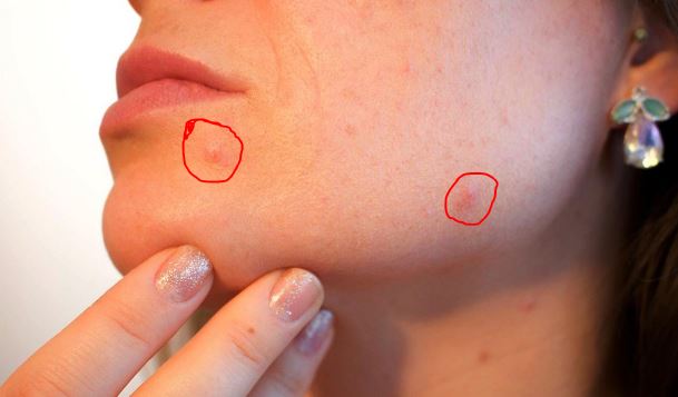 Blind Pimple On Nose Chin Get Rid Pop Causes Home Remedies To blind-pimple-on-nose-chin-get-rid-pop-causes-home-remedies-to