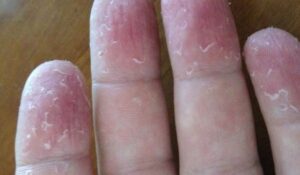 Peeling Fingertips Causes and How to Get Rid of Skin Peeling on ...