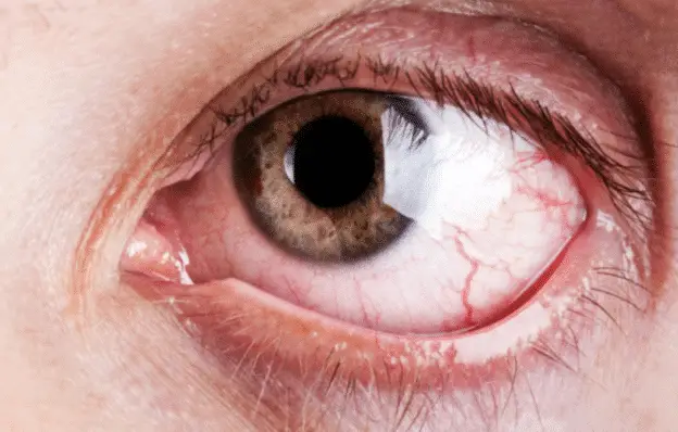 Gritty Eyes, Meaning, Causes, Symptoms, Treatment, Remedies – Treat ...